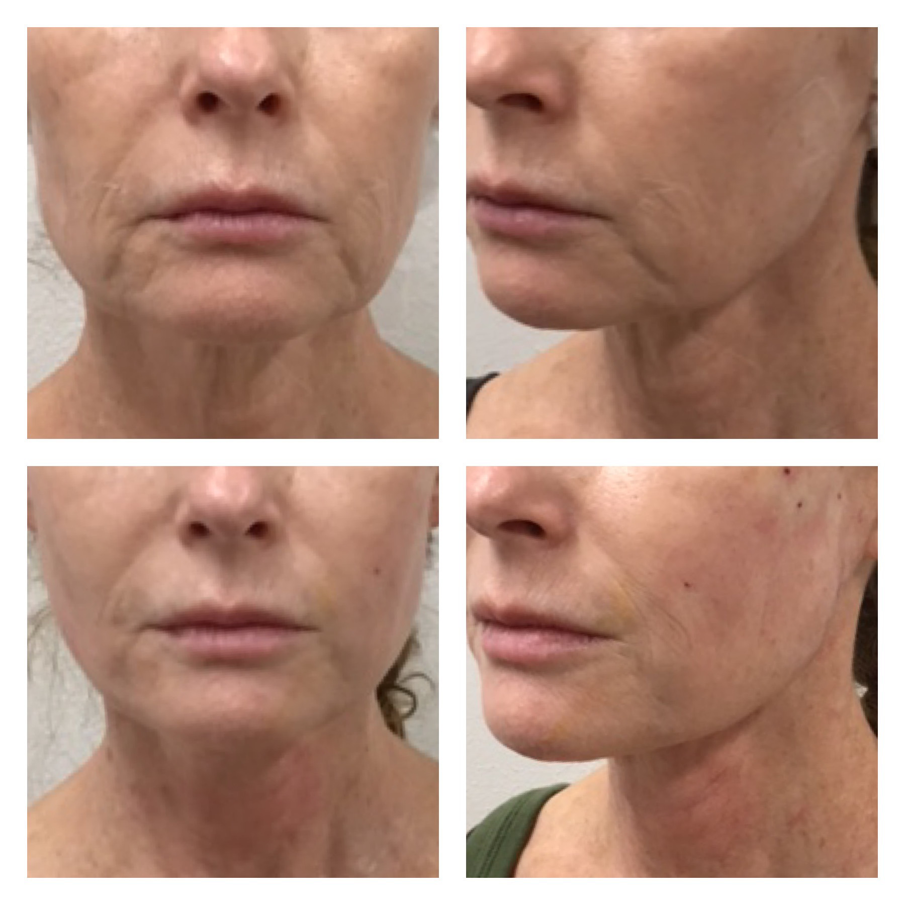 PDO Thread Lift | Newport Beach MedSpa PDO Thread Lift | Newport Beach MedSpa